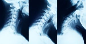 Cervical Instability - Causes & Best Treatment Options in 2023