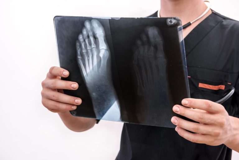Lateral Foot Pain: Causes, Symptoms, and Prolotherapy Treatment