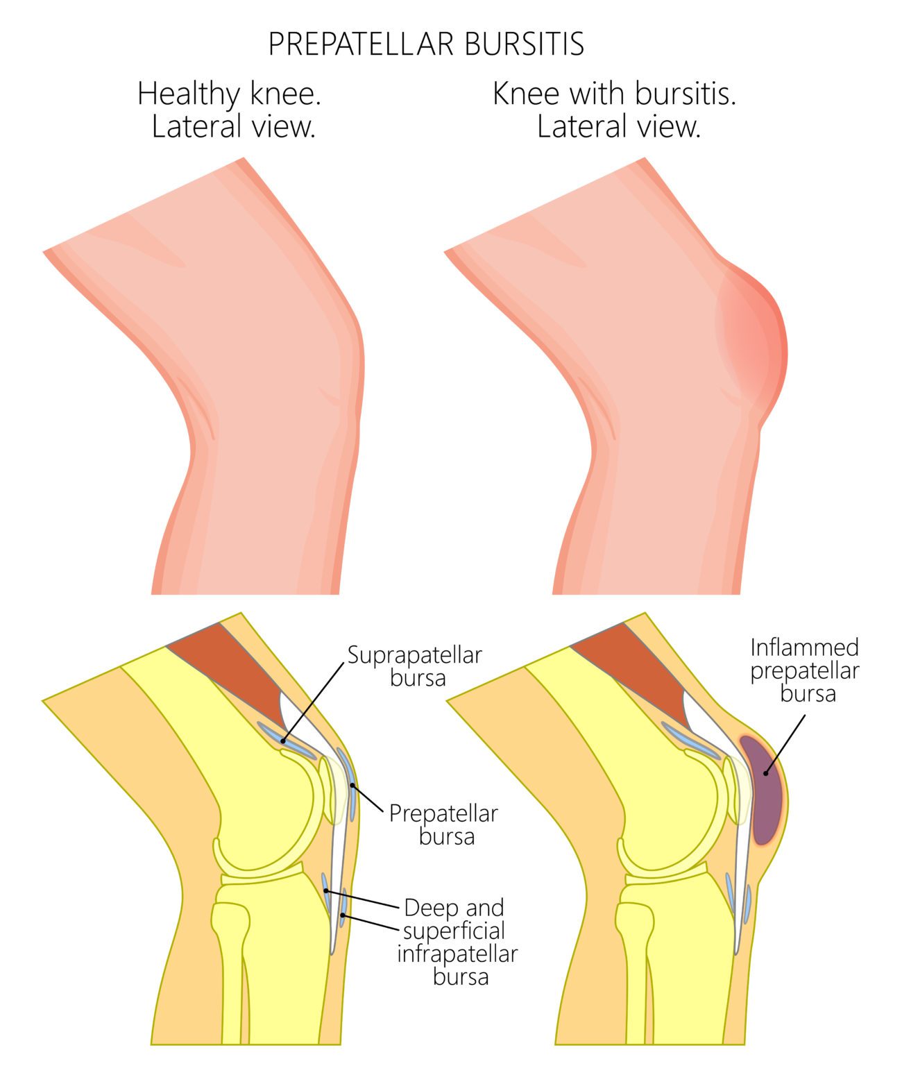 Housemaid's Knee (Prepatellar Bursitis): Treatment & Prolotherapy