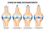 Knee Injections to Replace Cartilage: Options For Managing Pain