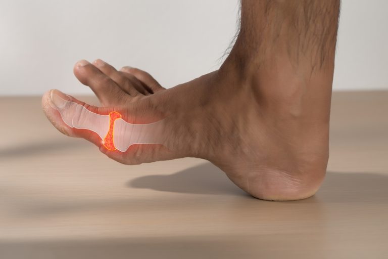 Arthritis in Big Toe: Causes, Relief, Prolotherapy & Expert Advice