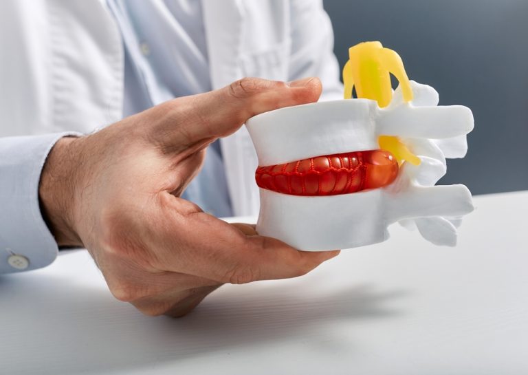 How to Get Herniated Disc Back in Place - ProHealth Prolotherapy Clinic