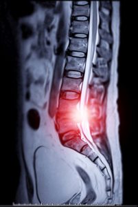 Signs Bulging Disc Getting Worse - ProHealth Clinic - Prolotherapy ...
