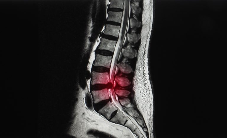 Understanding Lumbar Decompression Surgery