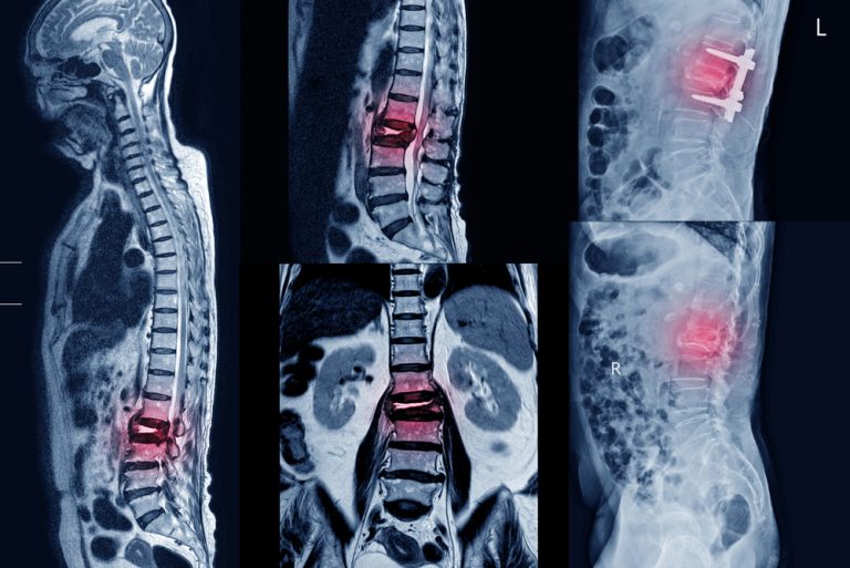 Decoding Lumbar Hernia: Understanding Risks & Treatments