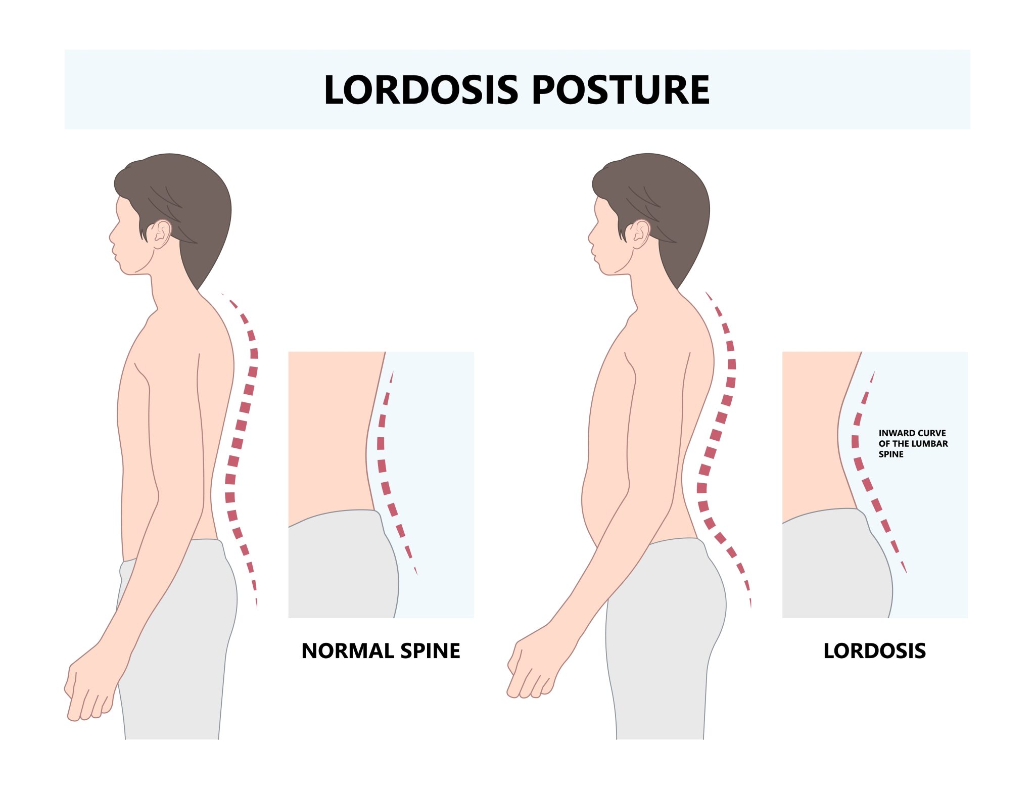 Hyperlordosis: Causes, Symptoms, and Effective Treatments