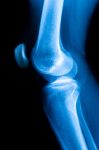 Managing Patella Alta: Diagnosis, Treatment, and Outcomes