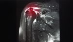 Calcification of the Shoulder Tendon: Causes & Symptoms