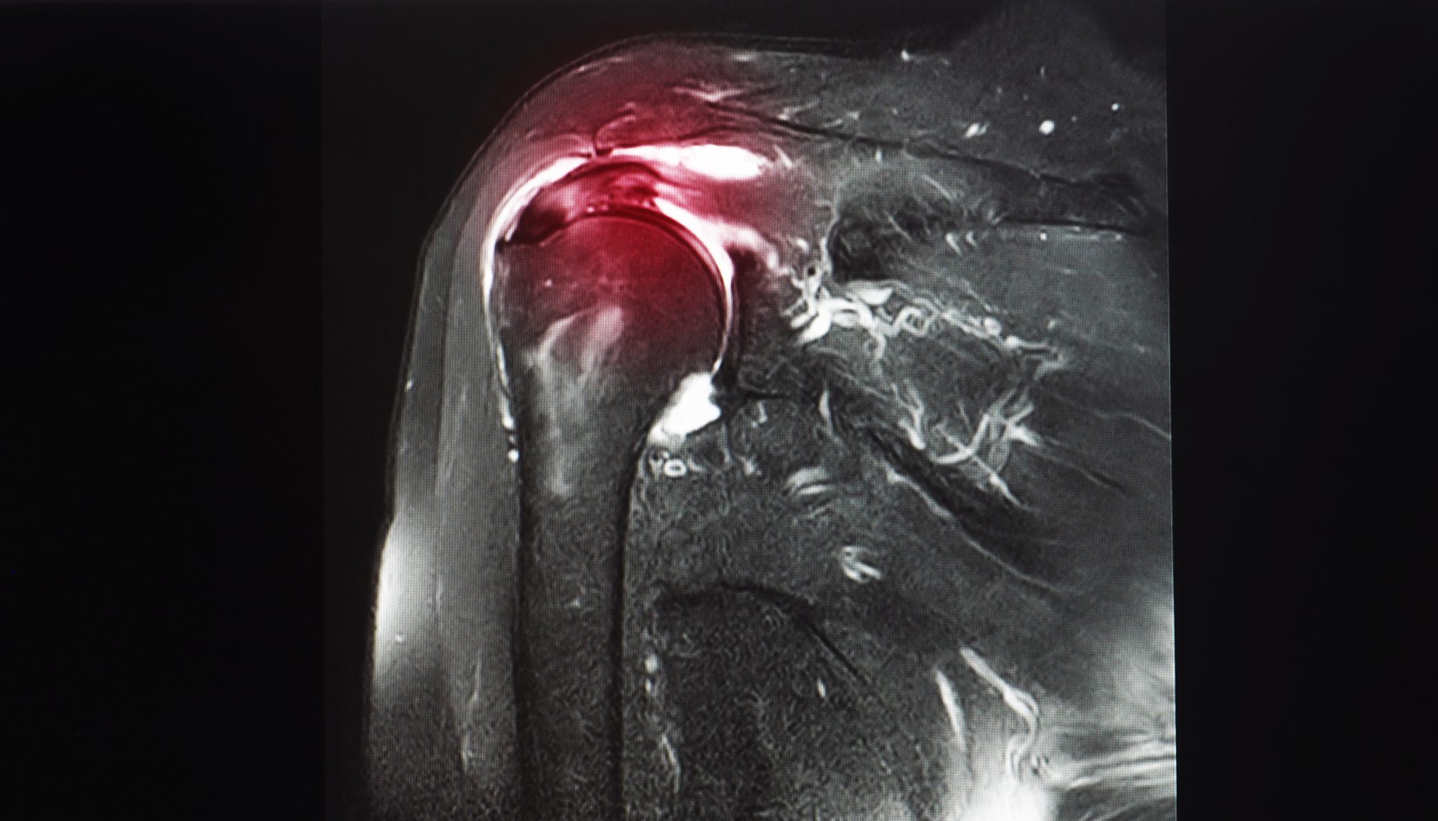 Calcification of the Shoulder Tendon: Causes & Symptoms