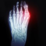 Bursitis Toe: Symptoms, Treatment, and Effective Prevention