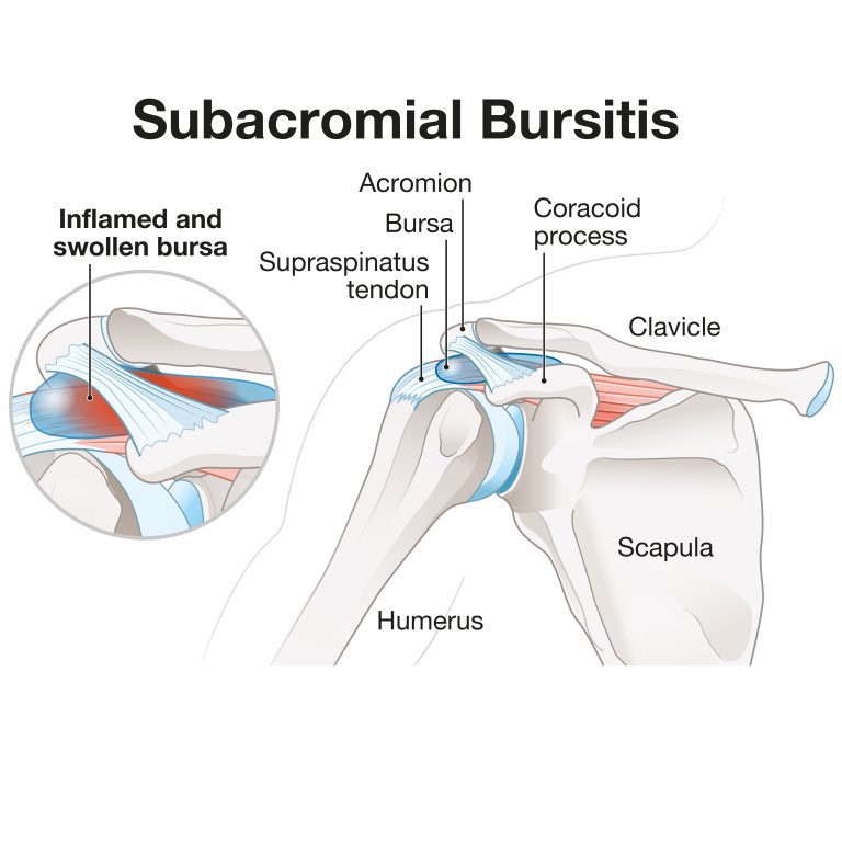 Subacromial Subdeltoid Bursitis: Symptoms, Treatment & Exercises